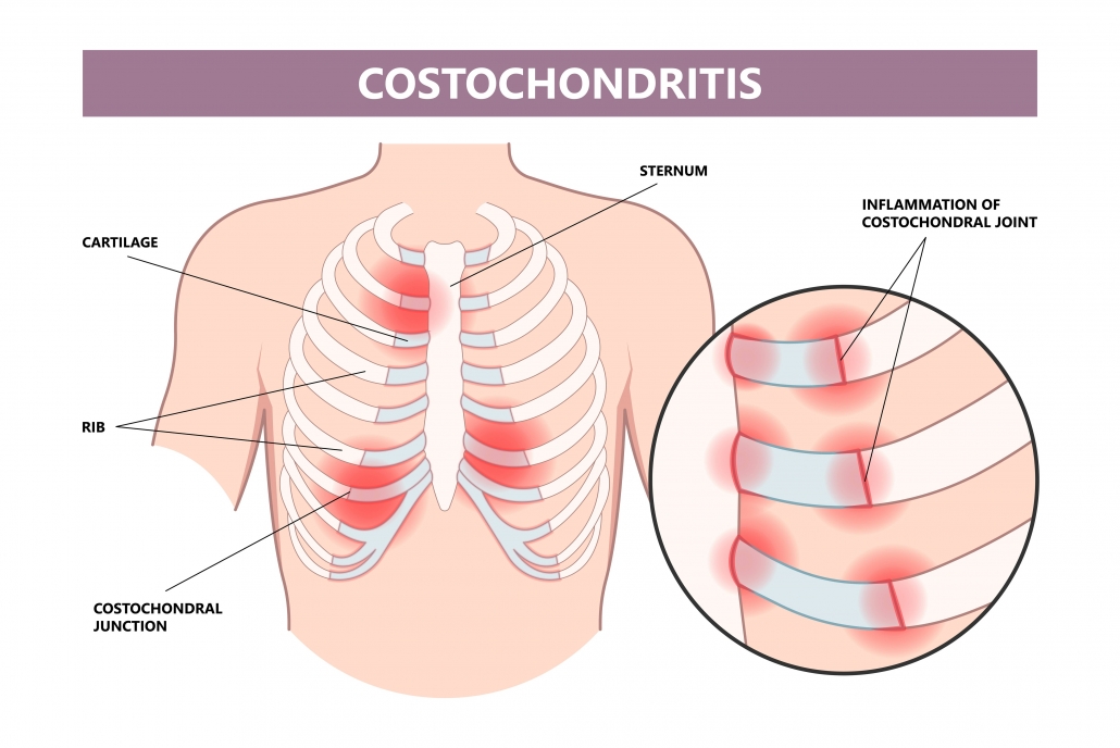 A Breakthrough In Treating Costochondritis With P DTR P DTR USA